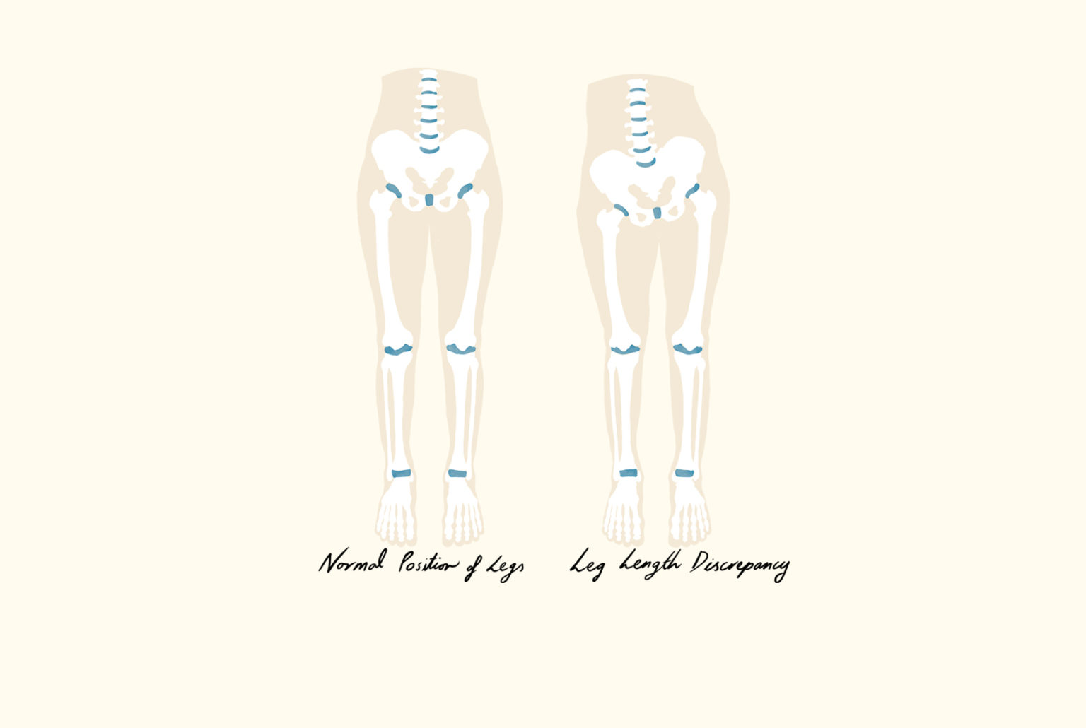 Leg Length Discrepancy | Northern Rivers Podiatry